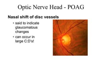 Glaucoma | PPT