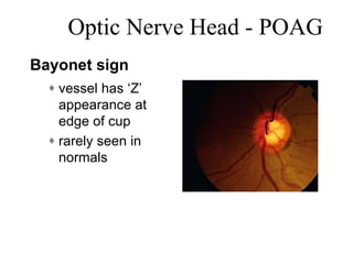 Glaucoma | PPT