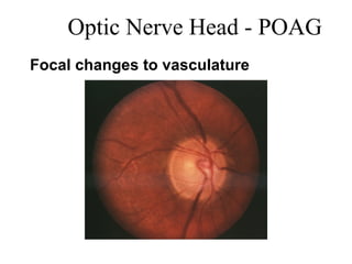 Glaucoma | PPT
