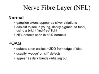 Glaucoma | PPT