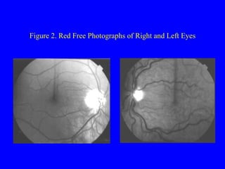 Hypotony Maculopathy | PPT