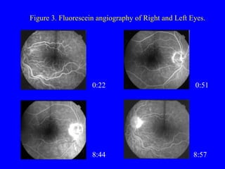 Hypotony Maculopathy | PPT