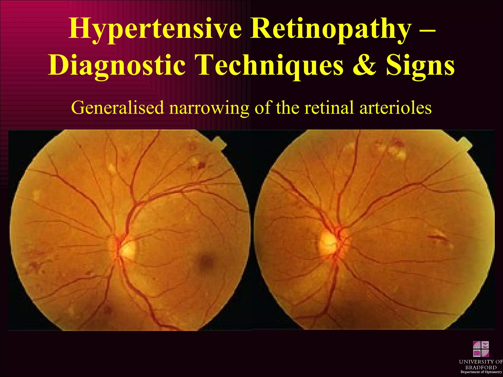 Hypertensive Retinopathy | PPT