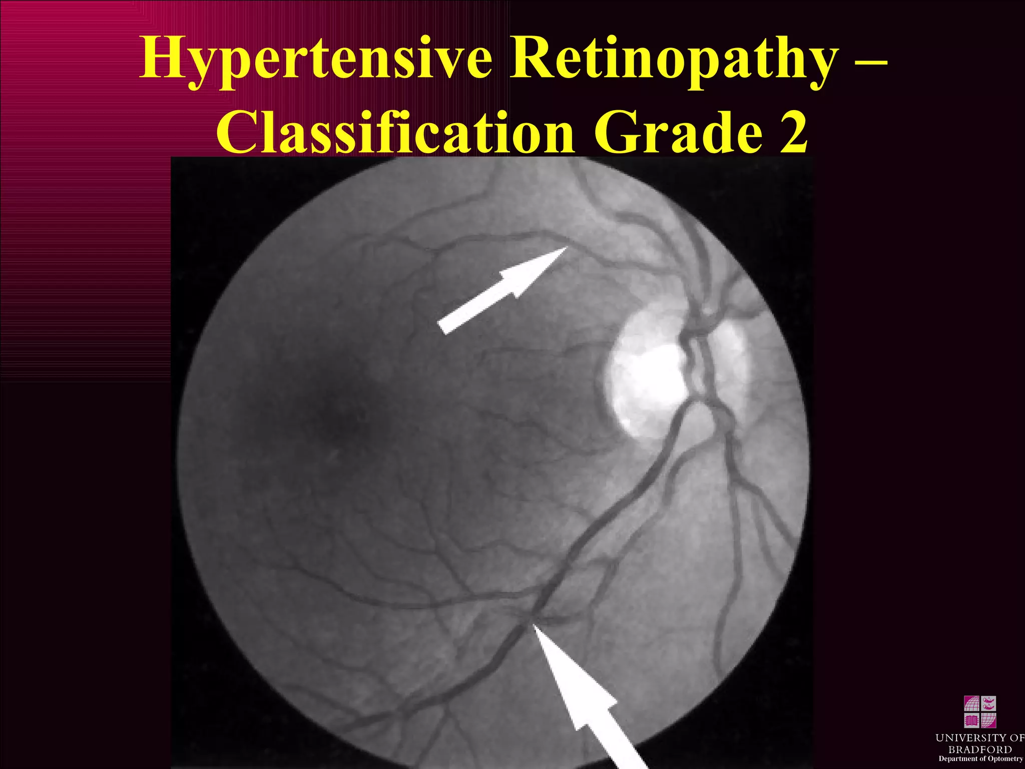 Hypertensive Retinopathy | PPT
