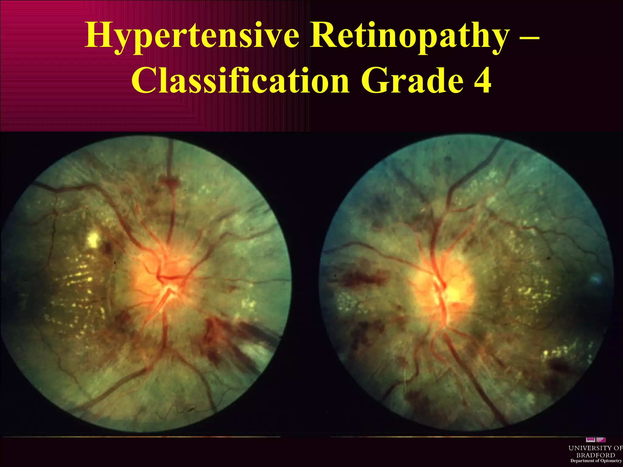 Hypertensive Retinopathy | PPT