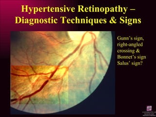 Hypertensive Retinopathy | PPT