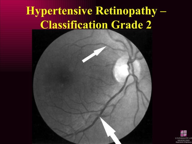 Hypertensive Retinopathy | PPT