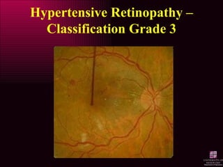 Hypertensive Retinopathy | PPT