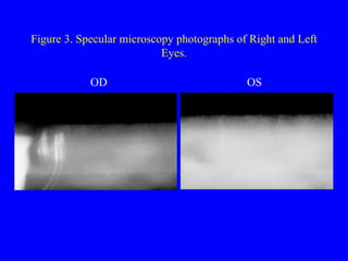 Iridocorneal endothelial (ICE) syndrome | PPT
