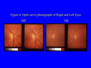 Iridocorneal endothelial (ICE) syndrome | PPT
