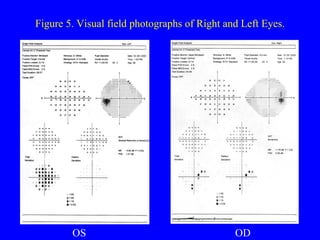 Iridocorneal endothelial (ICE) syndrome | PPT