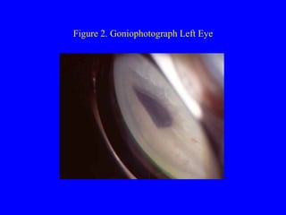 Iridocorneal endothelial (ICE) syndrome | PPT