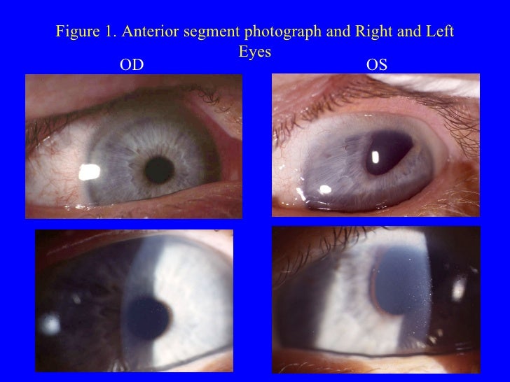 Iridocorneal endothelial (ICE) syndrome
