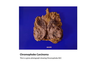 Renal Cell Carcinoma GrossMicroPath.pptx