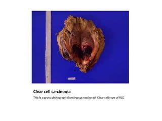 Renal Cell Carcinoma GrossMicroPath.pptx