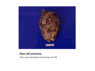 Renal Cell Carcinoma GrossMicroPath.pptx