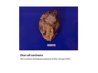 Renal Cell Carcinoma GrossMicroPath.pptx