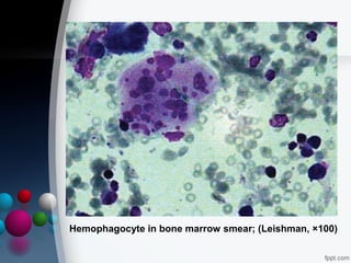Hemophagocytic syndrome. | PPT