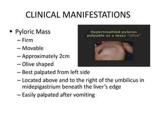 Pyloric Stenosis Olive Shaped Mass