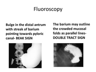 Double Track Sign Pyloric Stenosis