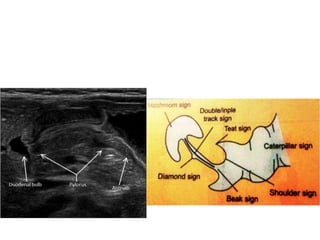 Pyloric Stenosis Shoulder Sign