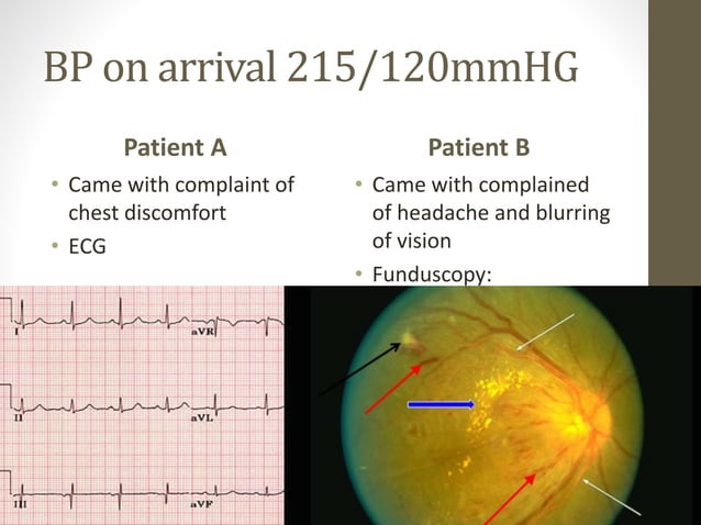 hypertension crisis junior hpt crisis pptx | PPT