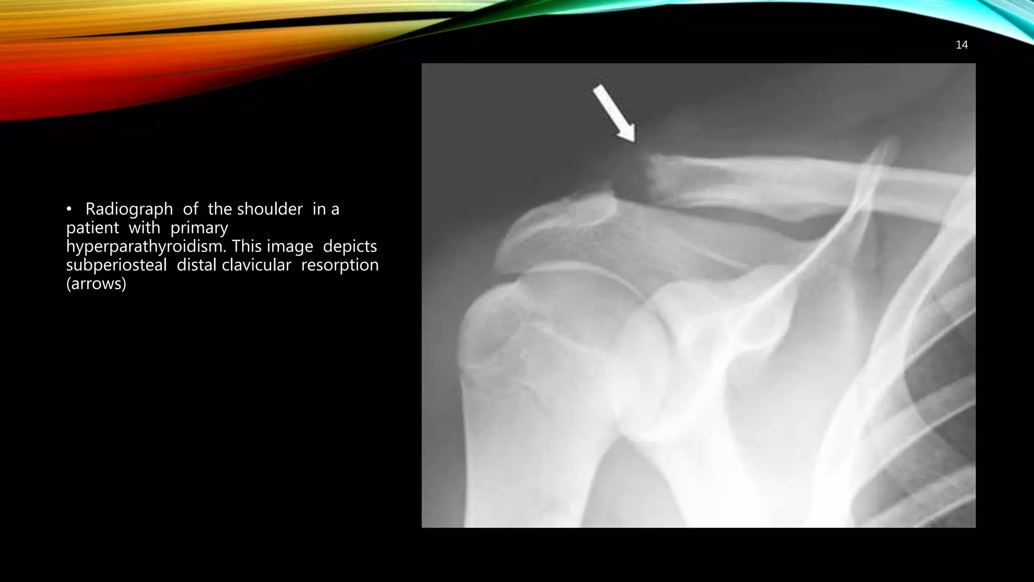 IMAGING IN HYPERPARATHYROIDISM | PPTX