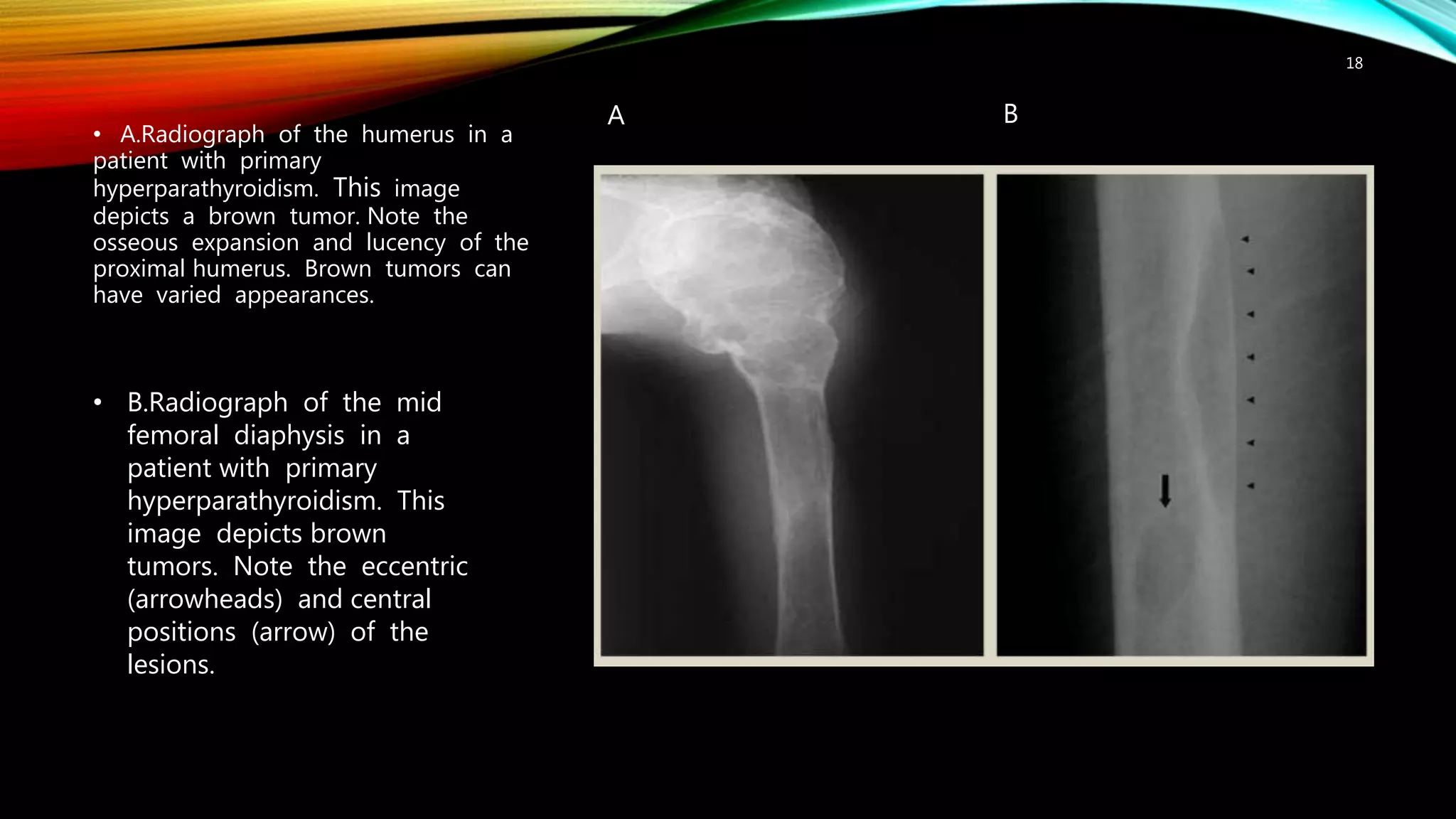 IMAGING IN HYPERPARATHYROIDISM | PPTX