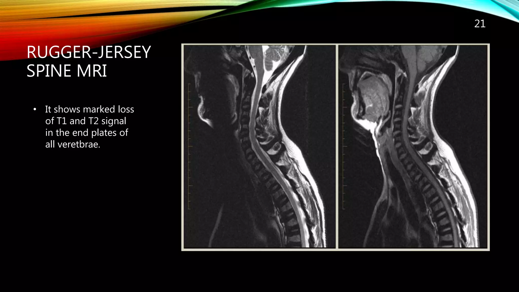IMAGING IN HYPERPARATHYROIDISM | PPTX