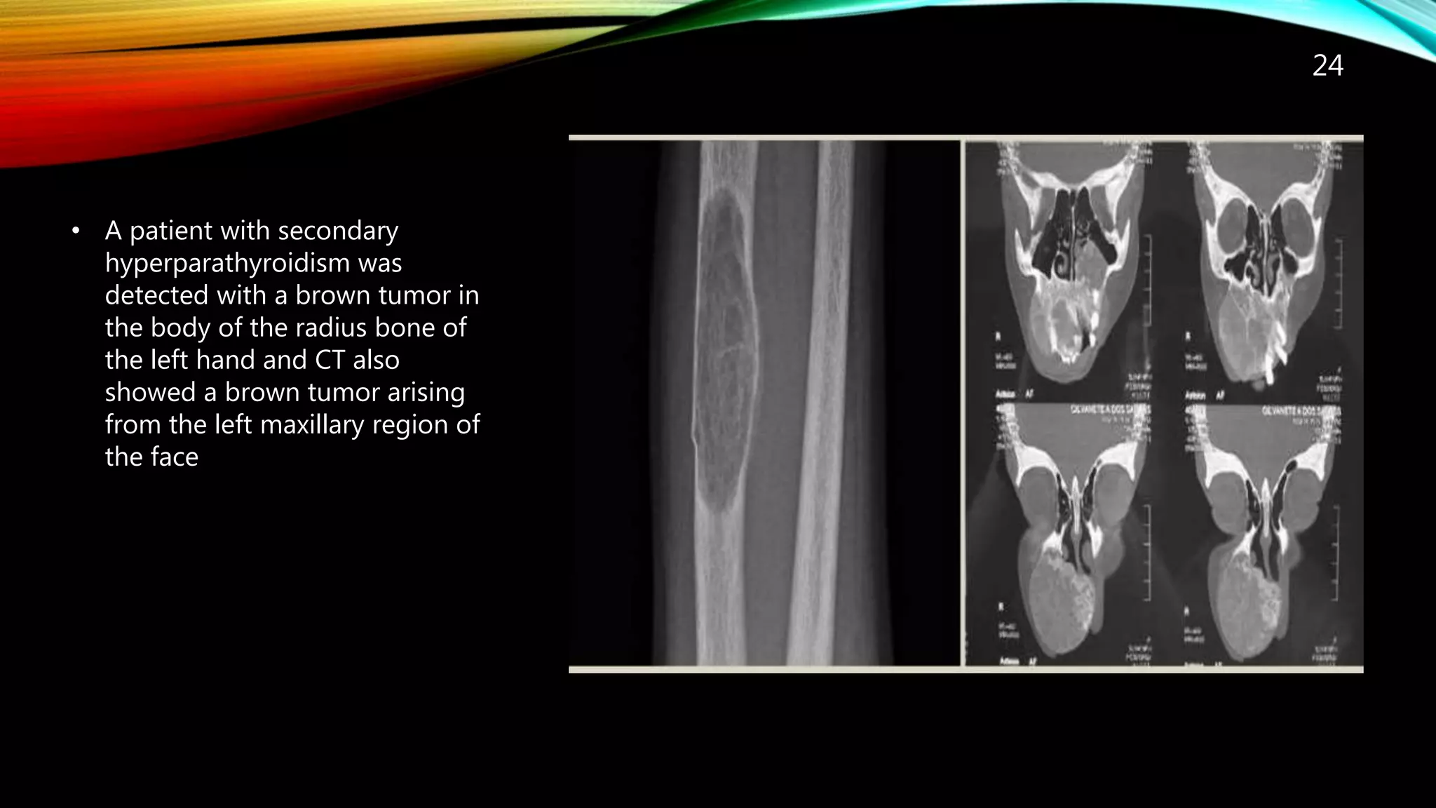 IMAGING IN HYPERPARATHYROIDISM | PPTX