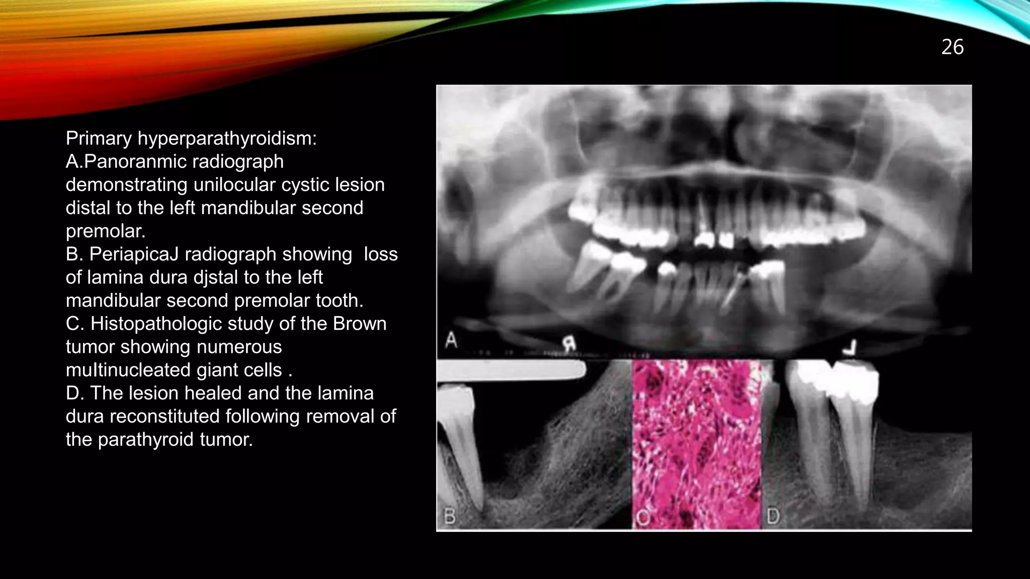 IMAGING IN HYPERPARATHYROIDISM | PPTX