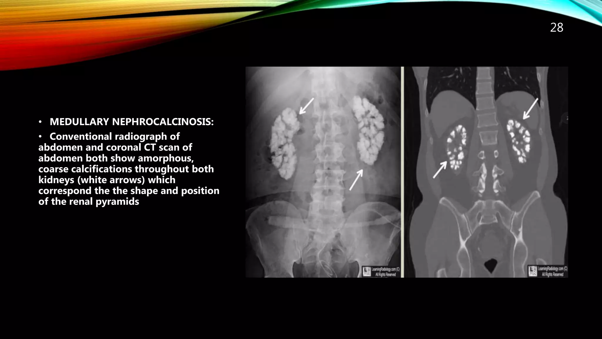 IMAGING IN HYPERPARATHYROIDISM | PPTX