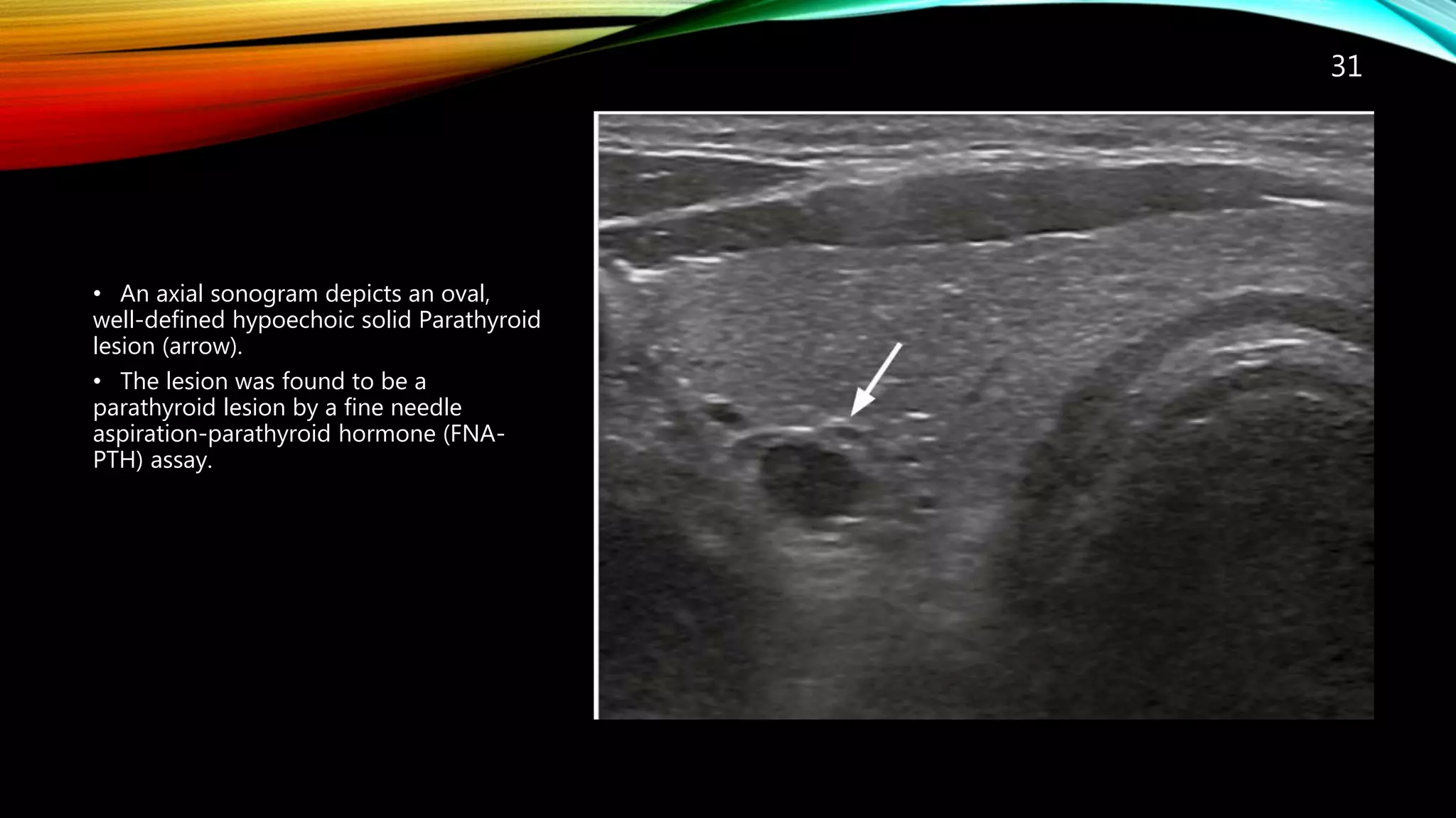 IMAGING IN HYPERPARATHYROIDISM | PPTX
