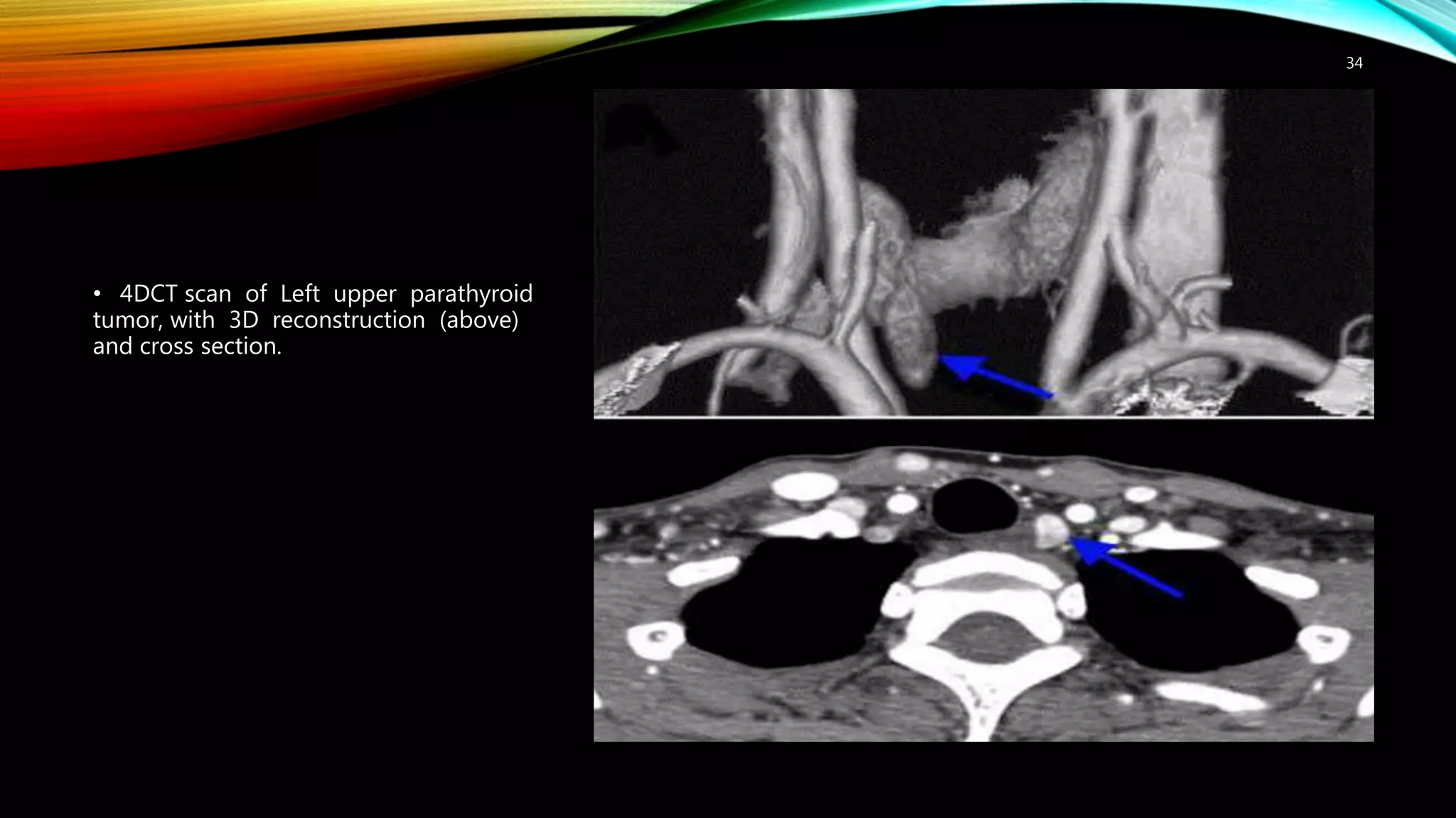 IMAGING IN HYPERPARATHYROIDISM | PPTX