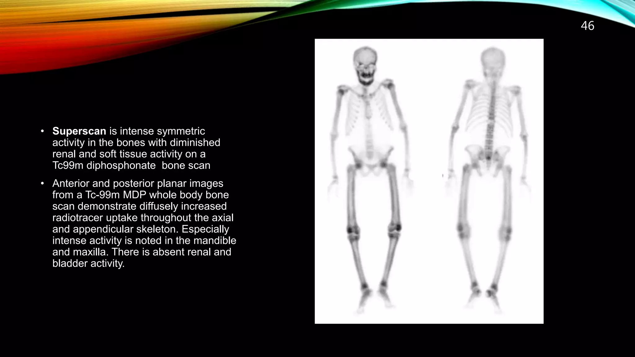 IMAGING IN HYPERPARATHYROIDISM | PPTX