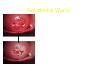 Hpv | PPT