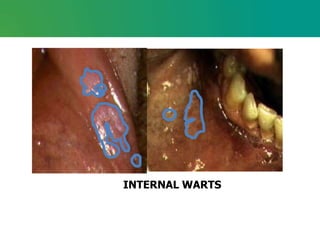 Human Papilloma Virus | PPTX