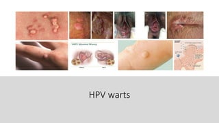Human Papilloma Virus(HPV).pptx