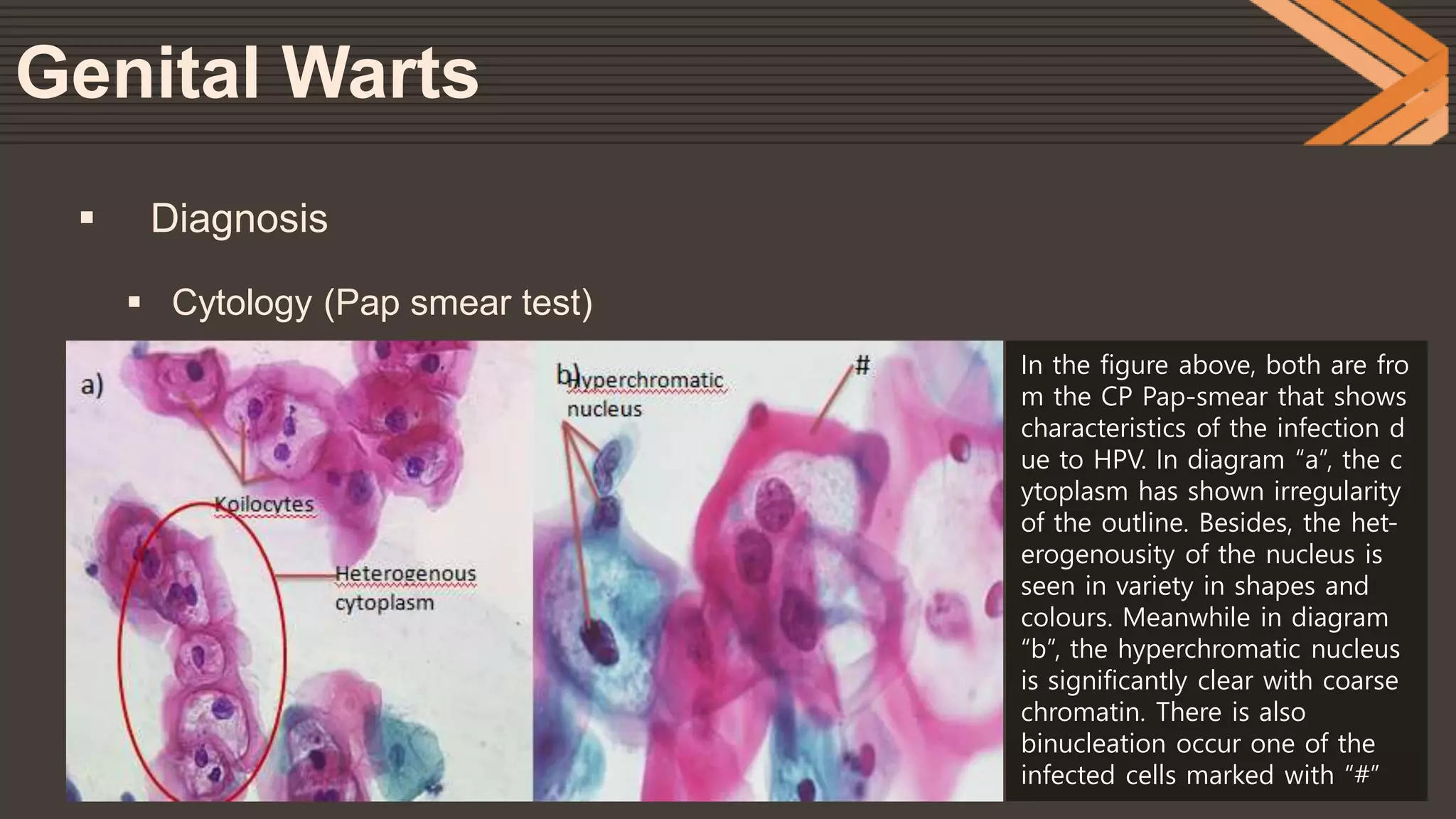 Genital Warts(HPV), Genital Herpes | PPTX