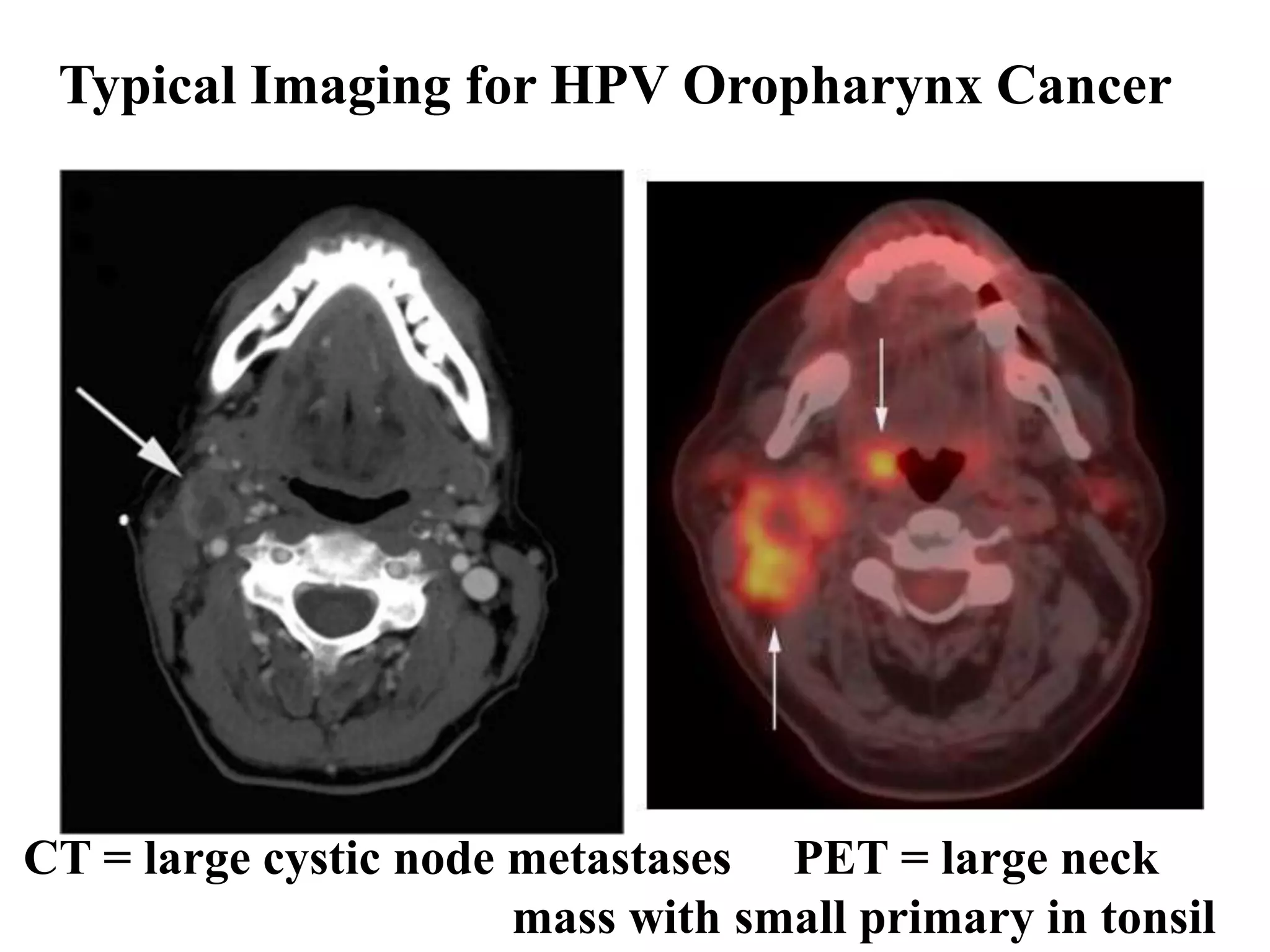 Hpv virus infections and oropharynx cancer | PPTX