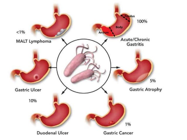 H pylori | PPTX