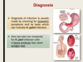 H pylori 2.pdf
