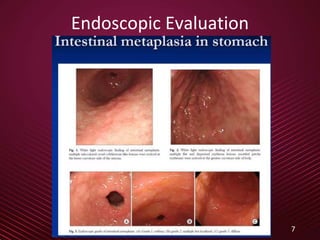 Helicobacter Pylori Infection: Management in 2020 | PPTX