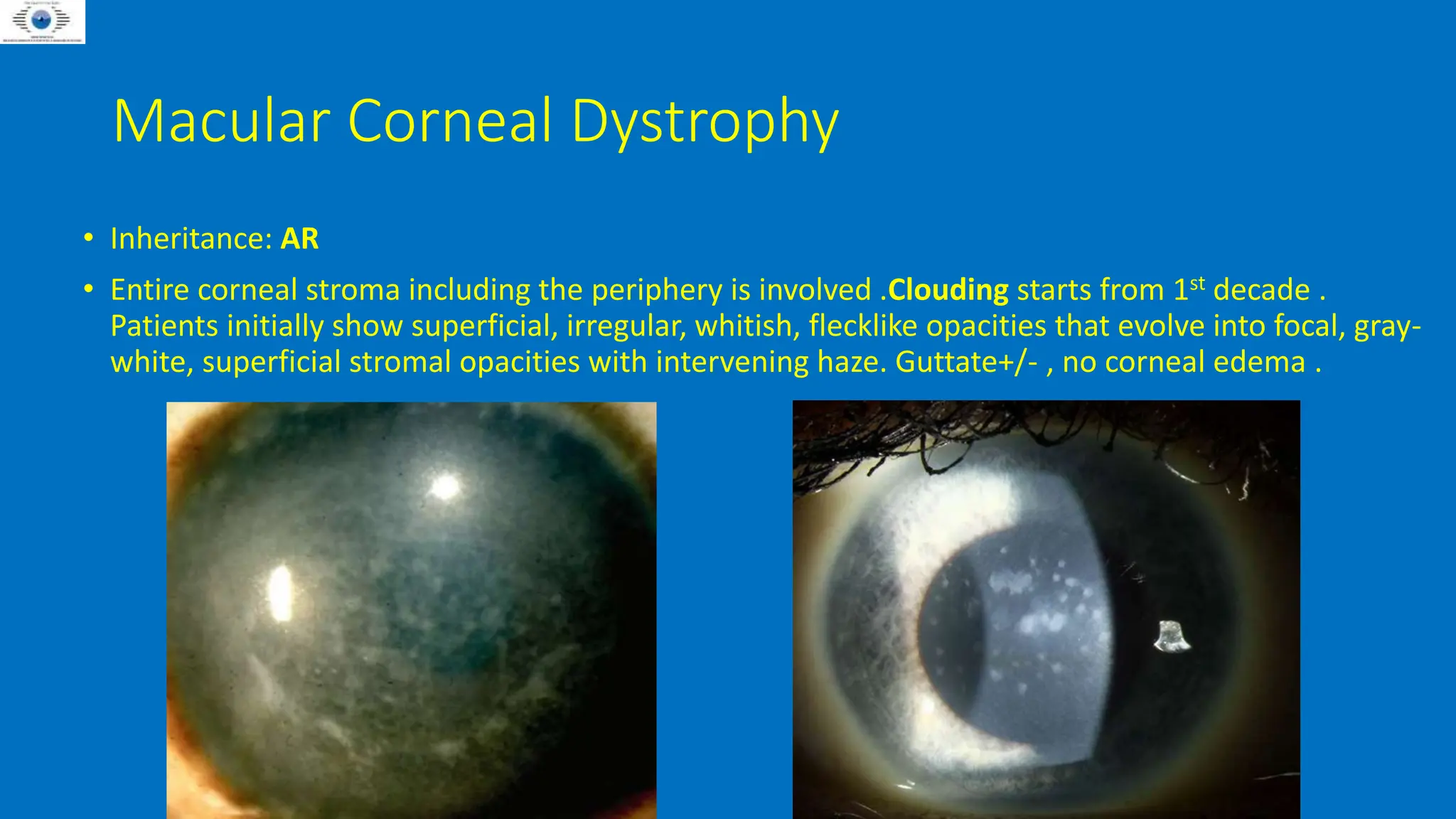 CORNEAL_DYSTROPHIES_Autosaved_DHBbwn.pptx