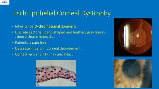CORNEAL_DYSTROPHIES_Autosaved_DHBbwn.pptx