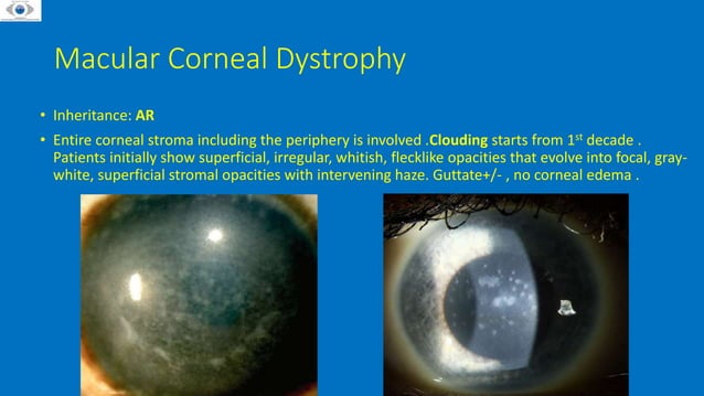 CORNEAL_DYSTROPHIES_Autosaved_DHBbwn.pptx