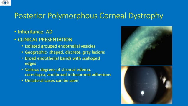 CORNEAL_DYSTROPHIES_Autosaved_DHBbwn.pptx