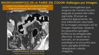 ENGROSAMIENTO(S) DE LA PARED DEL COLON: Hallazgos por Imagen. | PDF