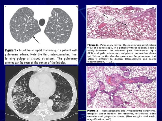 HRCT Reticular pattern | PPT