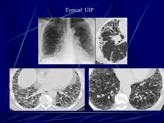 HRCT Reticular pattern | PPT